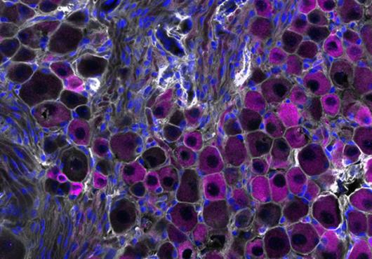 What Will It Take to End Tuberculosis? | Harvard Medical School